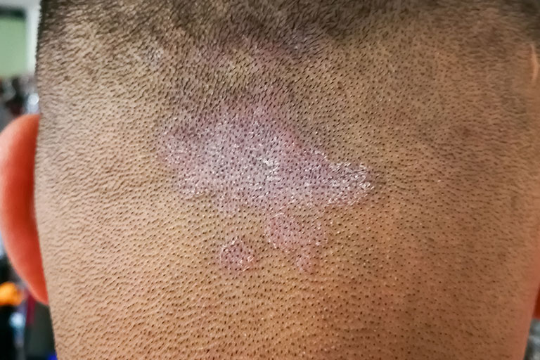 Hongos en el pelo: prevención y métodos eficaces de tratamiento