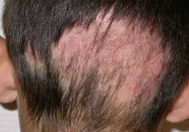 Cómo reconocer hongos en el pelo y tratamientos efectivos