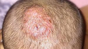 Hongos en el pelo: prevención y métodos eficaces de tratamiento
